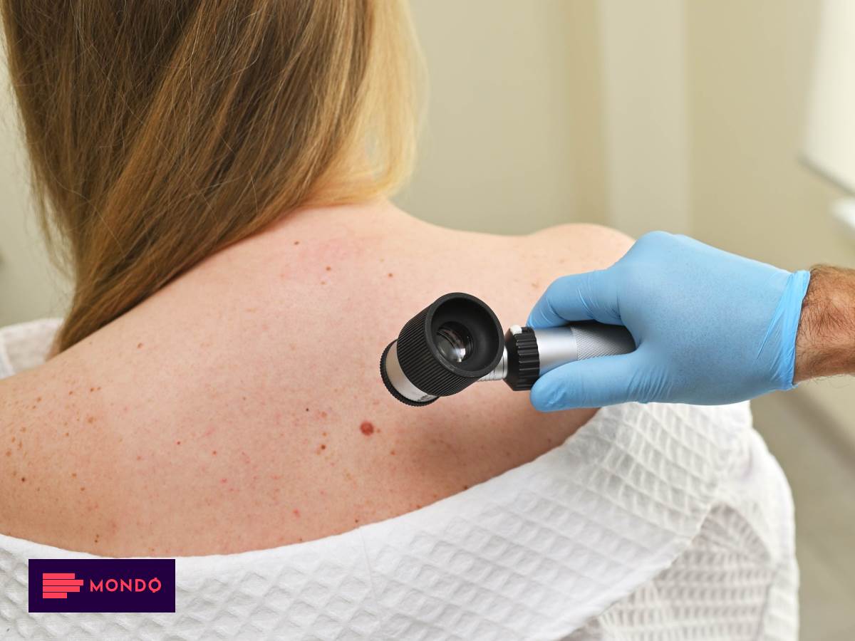 Broj oboljelih od melanoma u Srpskoj u ekspanziji | Info | Društvo
